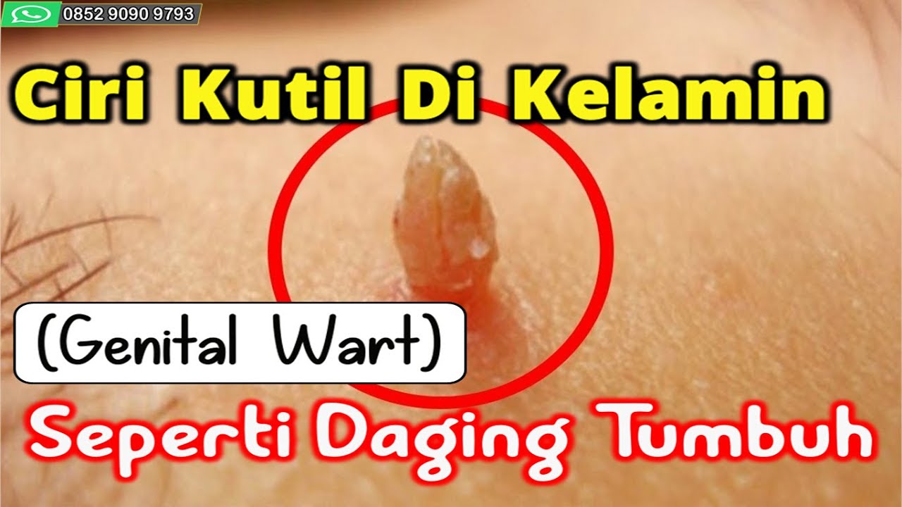 Ciri Kutil Di Kelamin (Genital Wart) Seperti Daging Tumbuh - YouTube