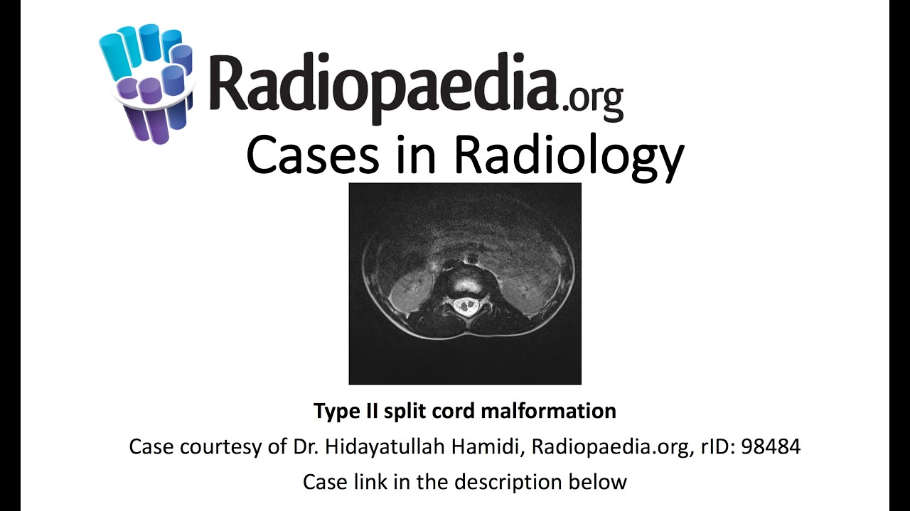 Type II split cord malformation (Radiopaedia.org) Cases in Radiology ...