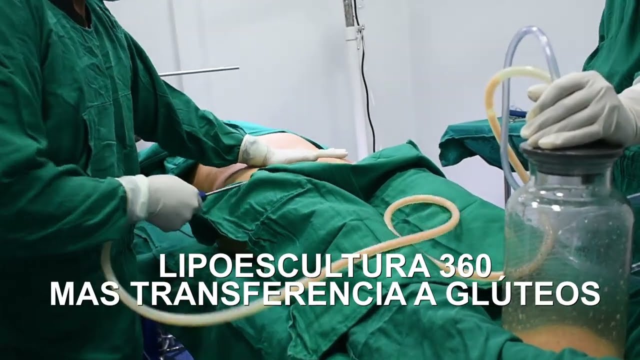 LIPO 360 CON TRANSFERENCIA A GLÚTEOS | F' ESTHÉTIQUE - YouTube