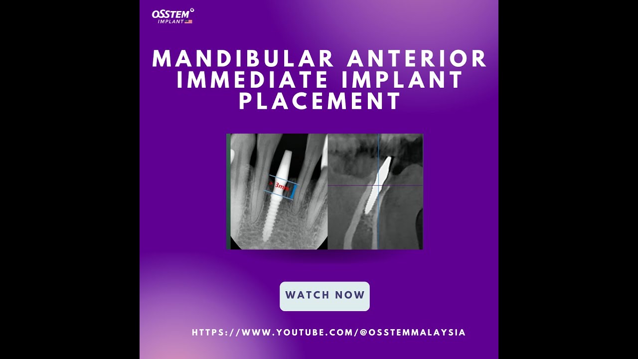[Master Course - SURGERY] Mandibular anterior immediate implant ...