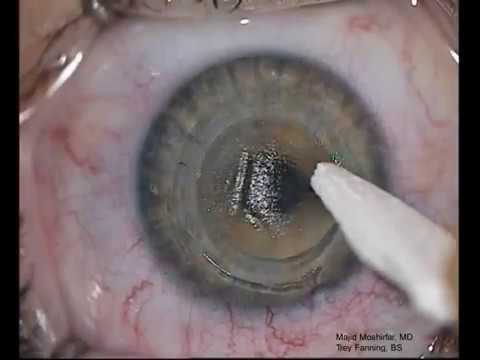 Toric Small Incision Lenticule Extraction (SMILE) Procedure to Correct ...