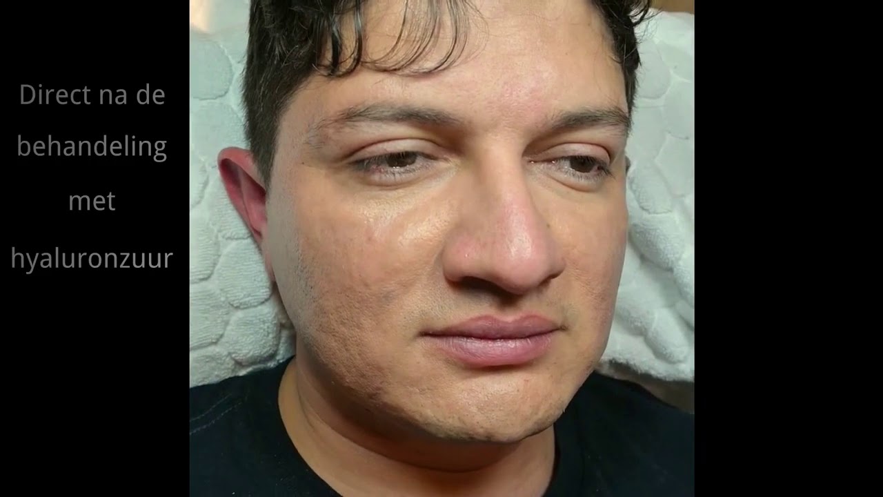 littekencorrectie en liquid facelift met hyaluronzuur - YouTube