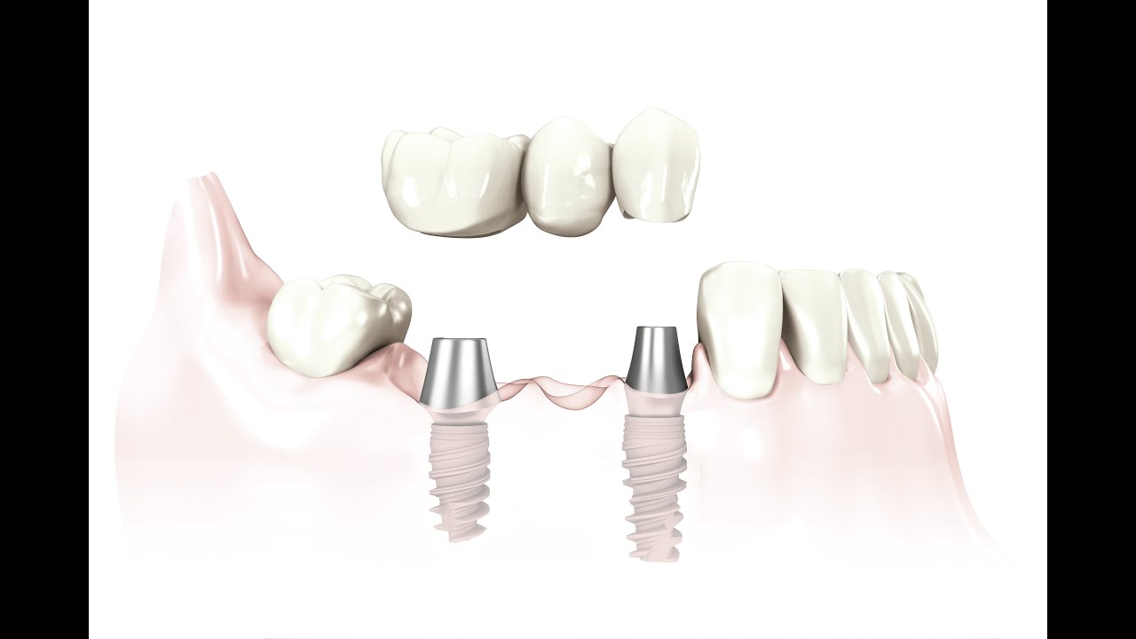 3 unit bridge on implants - YouTube
