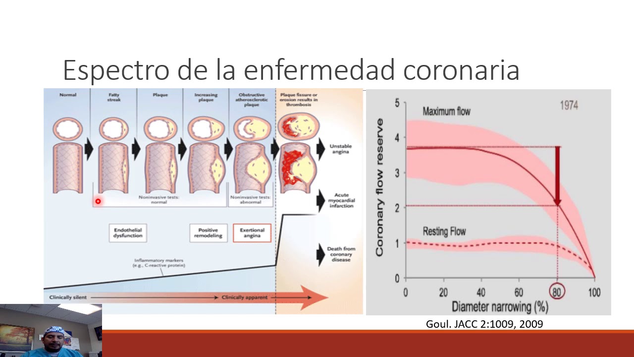 Chest pain evaluation (Spanish). Evaluación del dolor precordial y ...