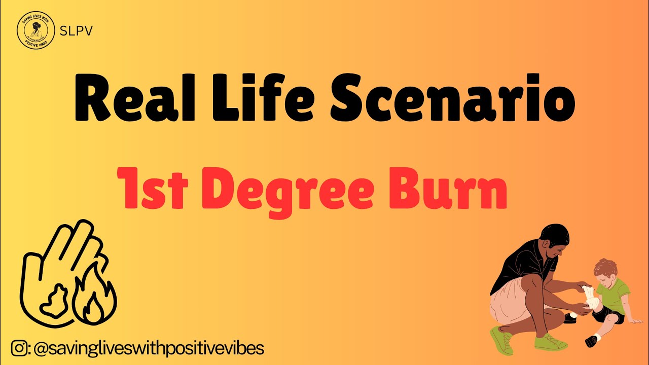 1st Degree Burn: Real Life Scenario - YouTube
