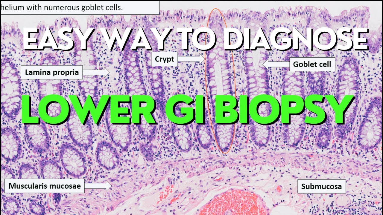 "Mastering Lower GI Biopsy Diagnosis Made Easy! | A Step-by-Step ...