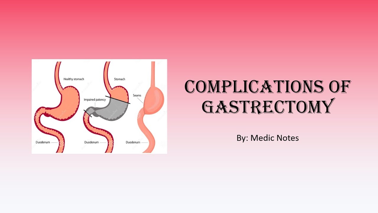 Complications of gastrectomy - YouTube
