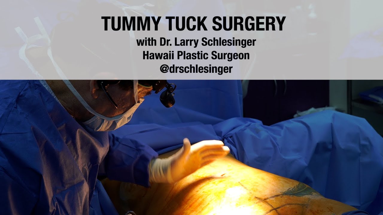 TUMMY TUCK SURGERY (GRAPHIC), BY DR. LARRY - YouTube