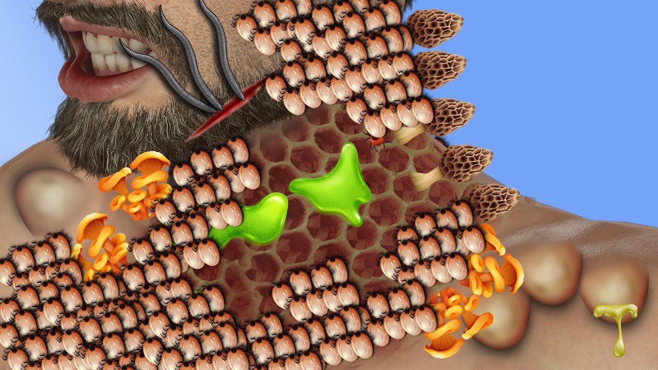 ASMR Remove Maggots & Worm Infected Neck | Severely Infected Animation ...