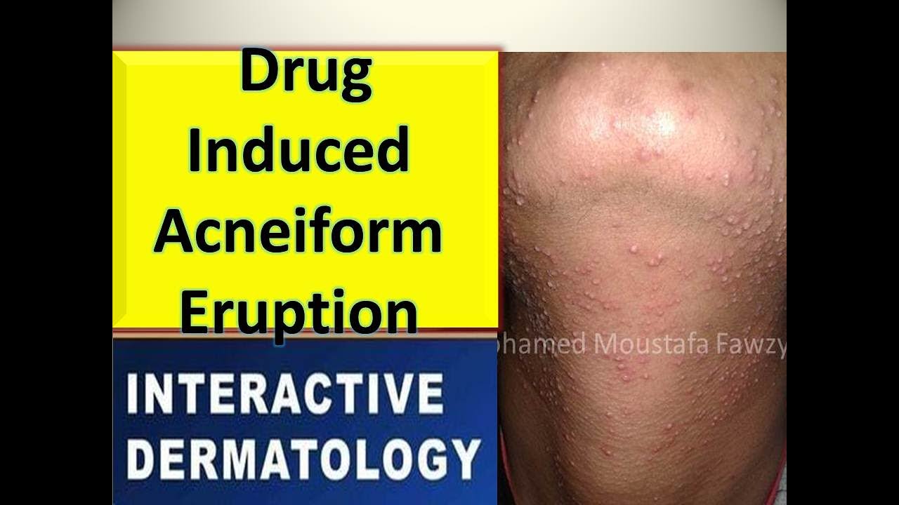 Drug induced acneiform eruption - YouTube