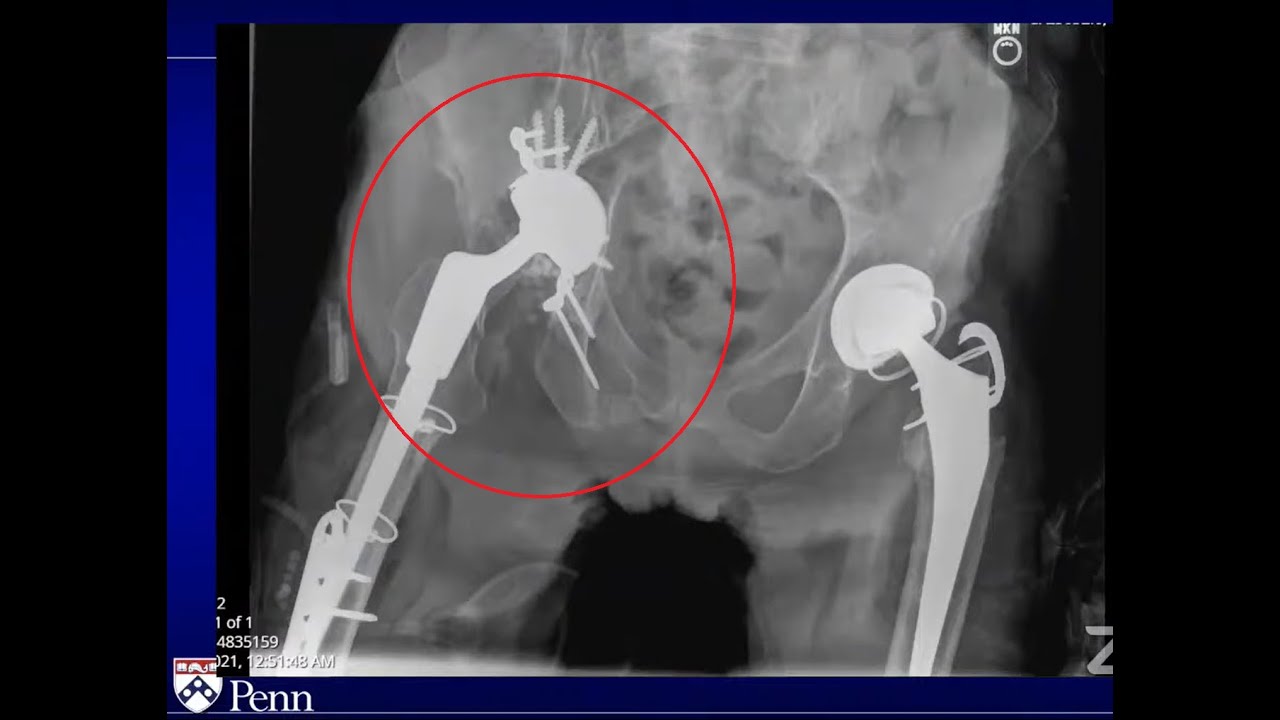 Acetabular Bone Loss and Pelvic Discontinuity - YouTube