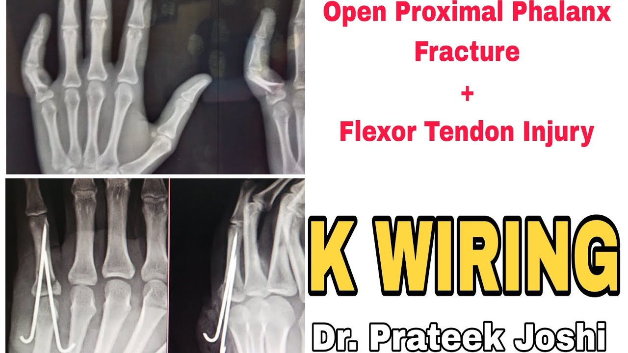 Open Proximal Phalanx Fracture with Tendon Injury | K wiring | Dr ...