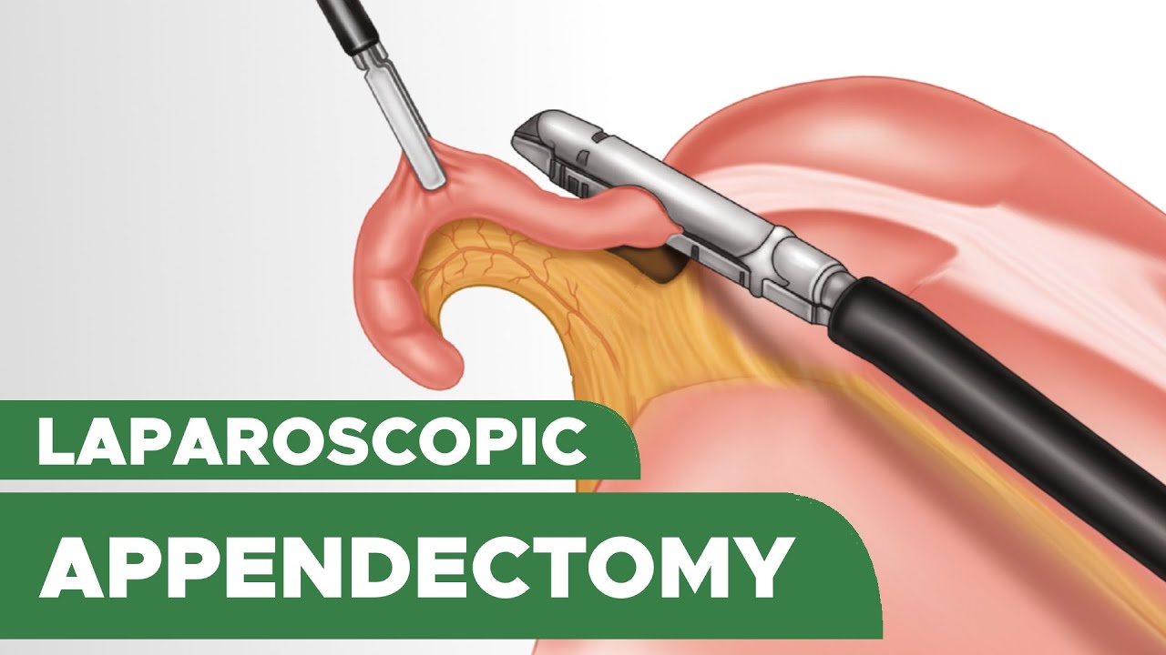 Laparoscopic Appendectomy - YouTube