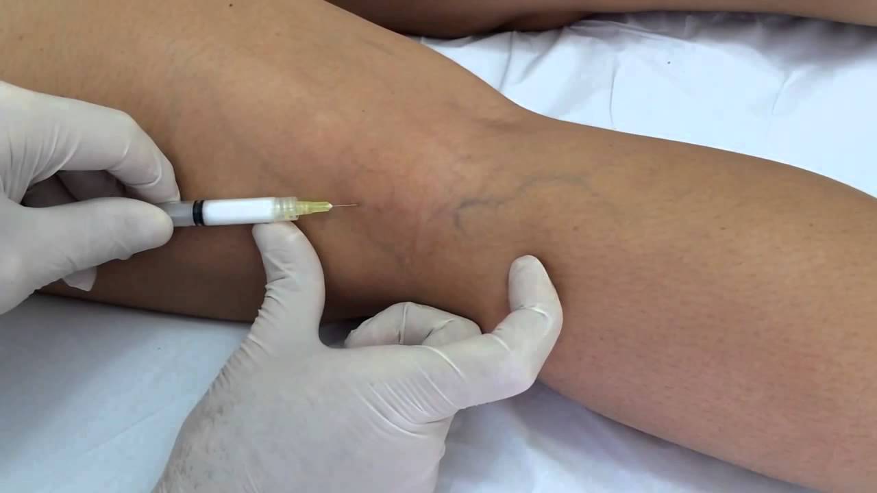 Escleroterapia de várices con microespuma - YouTube