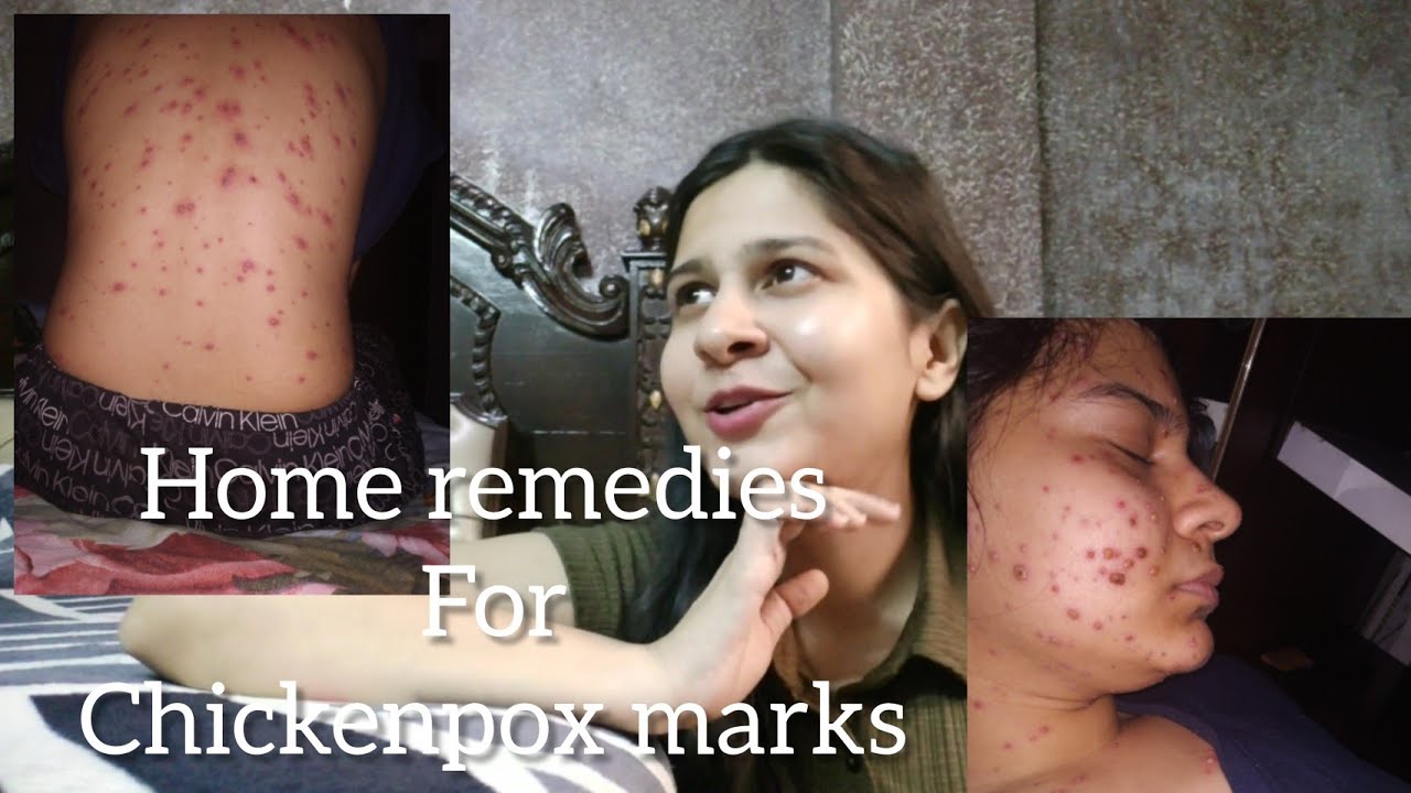 Home remedies for chickenpox (DIY) (Hindi) - YouTube