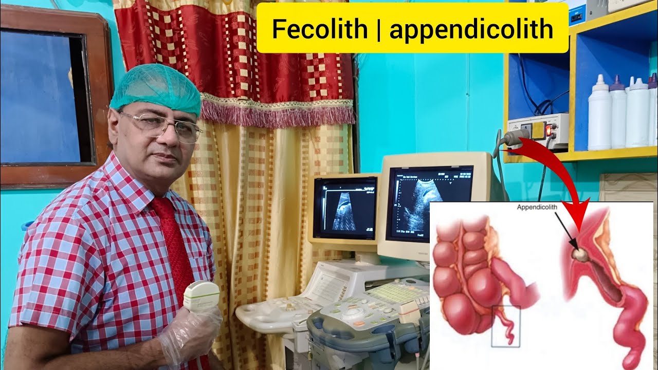Fecolith | Appendicoliths | Appendicitis | RIF pain | #medicaleducation ...