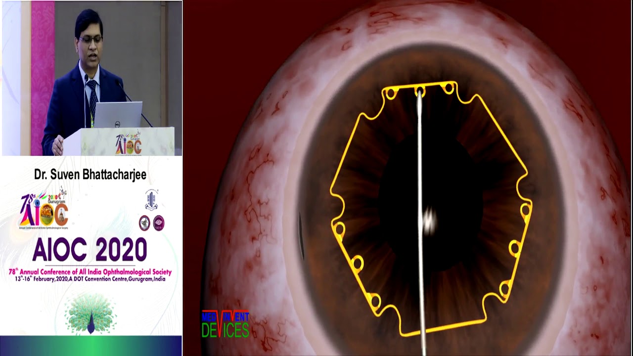 AIOC2020-IC35 - Dr.Suven Bhattacharjee T6 Small pupils, IFIS & pupil ...