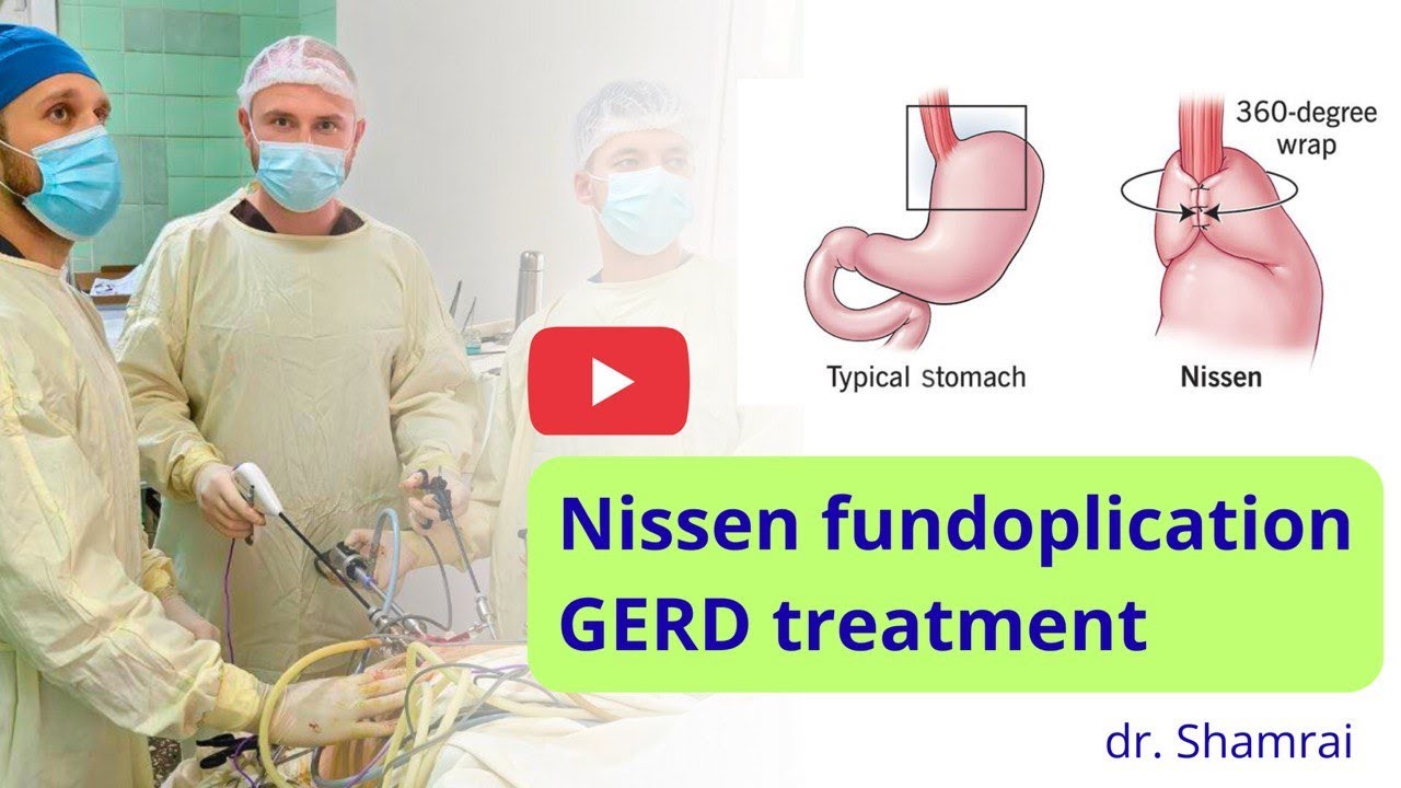 Esophageal reflux (GERD) treatment - Lap Nissen fundoplication - YouTube