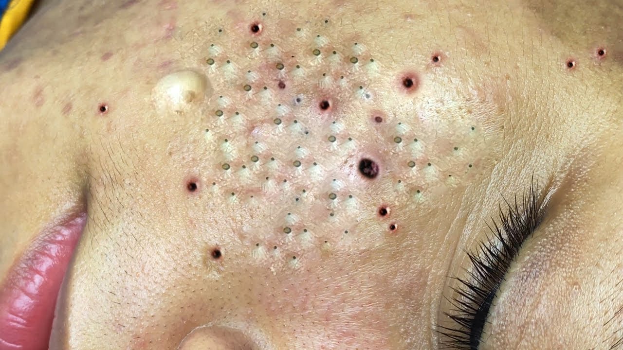 loan nguyen acne & spa #574 - YouTube