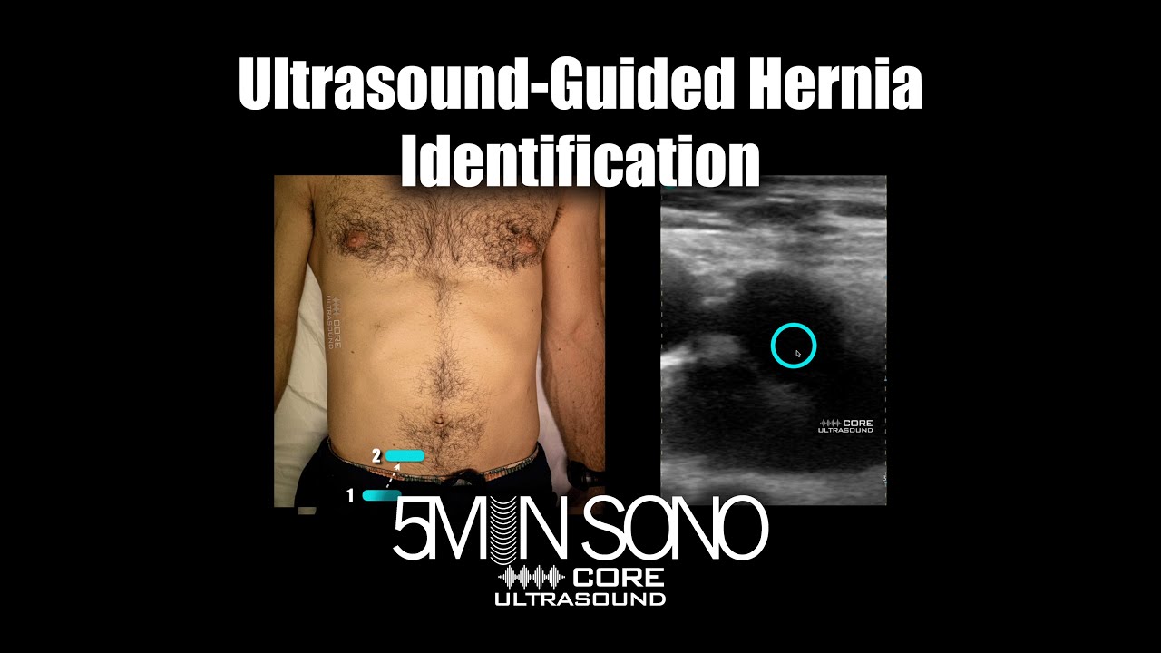 Ultrasound Guided Hernia Identification YouTube