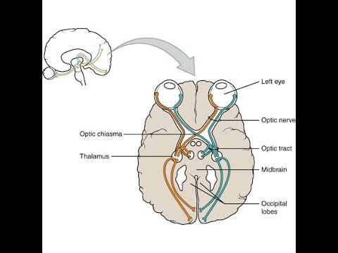 Mid Sagittal Lesion of the optic chiasma and its effect - YouTube