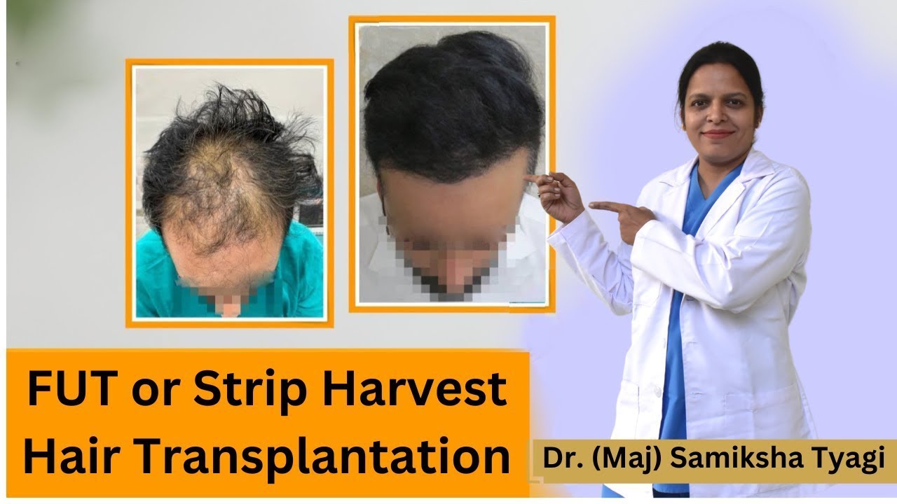 FUT or Strip Harvest Hair Transplantation | Pros & Cons FUT Hair ...
