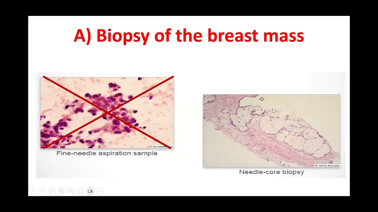 Breast cancer Staging workup, part 1/2, Basics of Breast cancer course ...