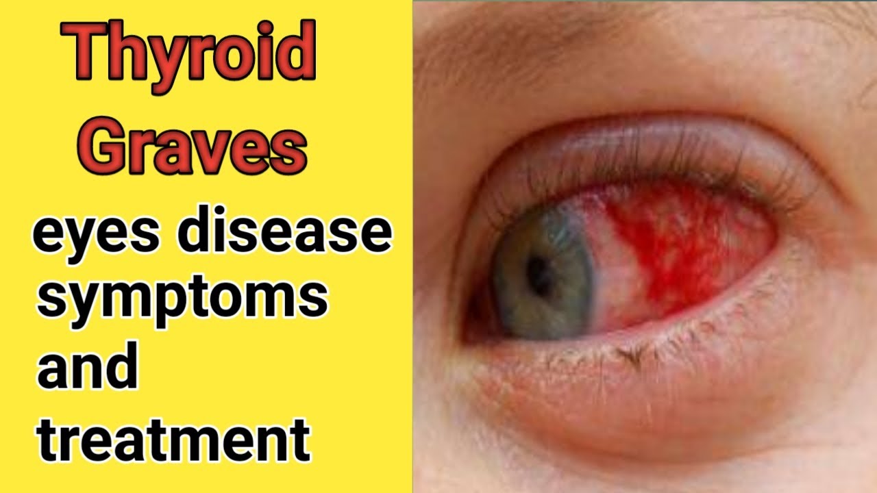 Thyroid Eye Disease | Graves Disease Treatment - YouTube