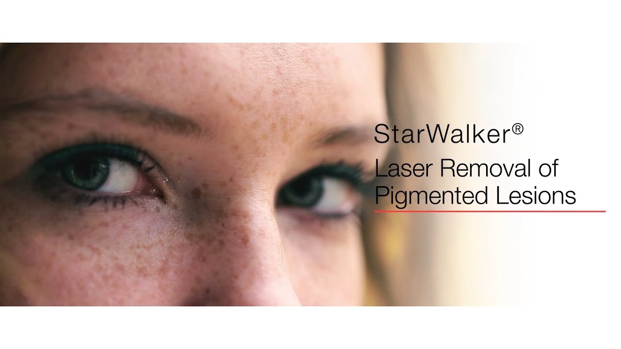 Laser Removal of Pigmented Lesions - YouTube