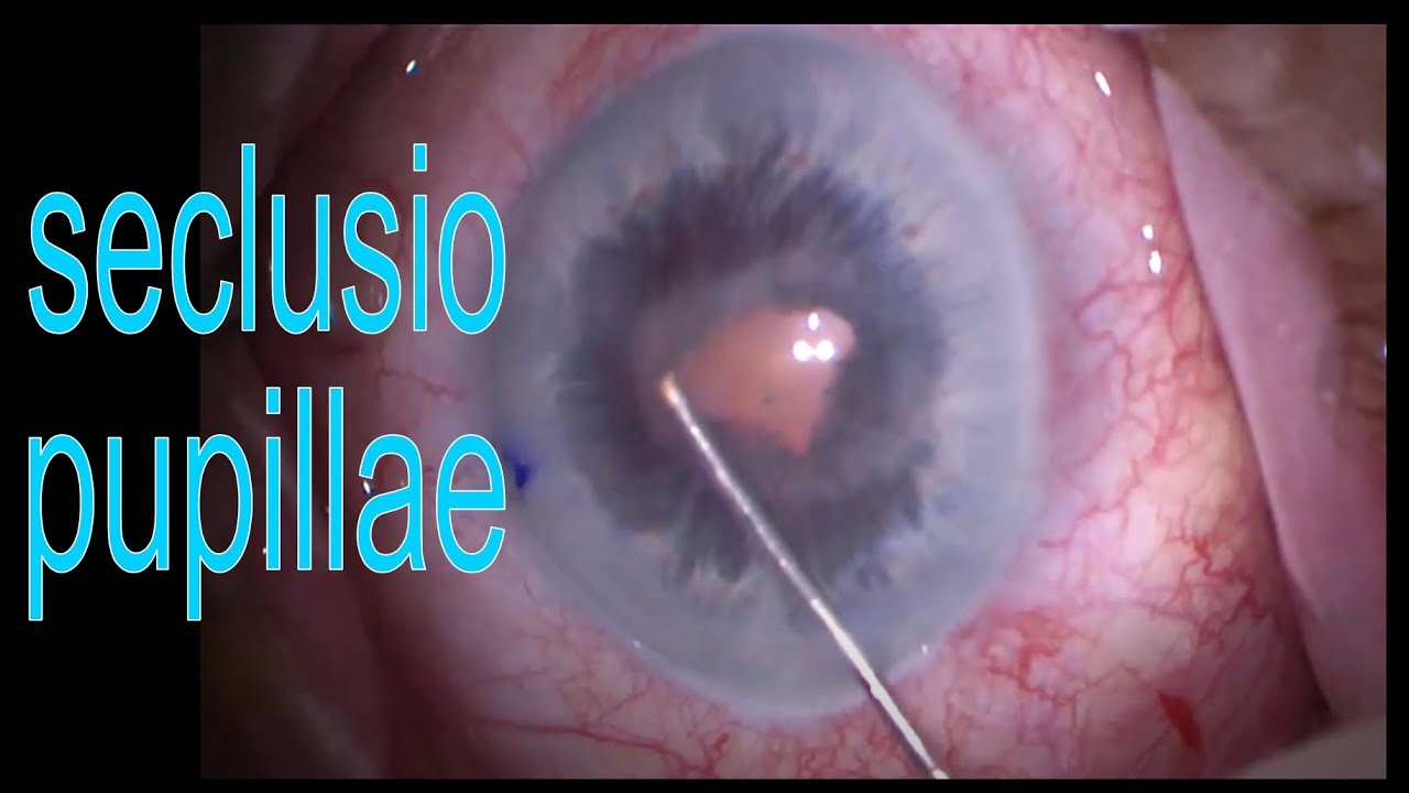 Iris Bombe! - secluded pupil - YouTube