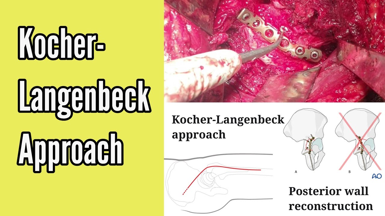 Posterior wall of acetabulam reconstruction || Kocher-Langenbeck ...