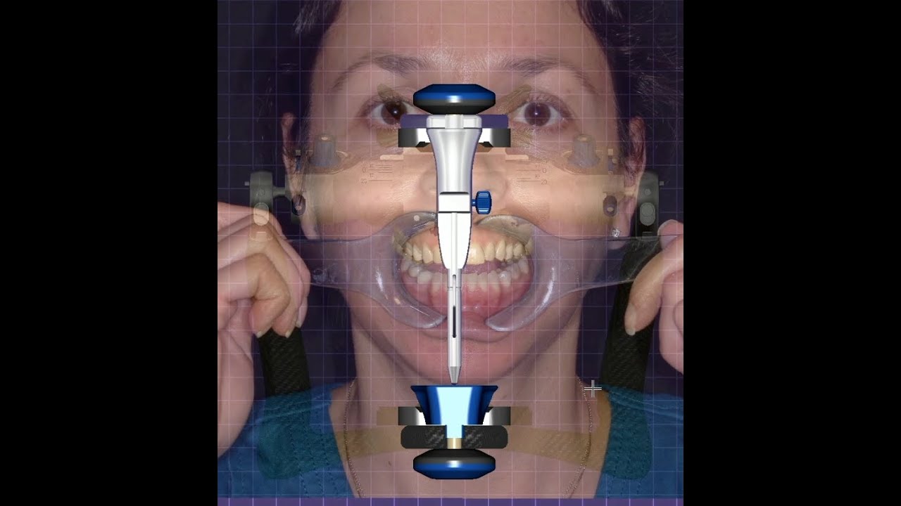 Exocad Digital Articulator-Zebris JMA - YouTube