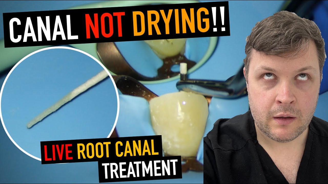 Huge Central Incisor Root Canal with Apical Gauging & Drying Struggles ...