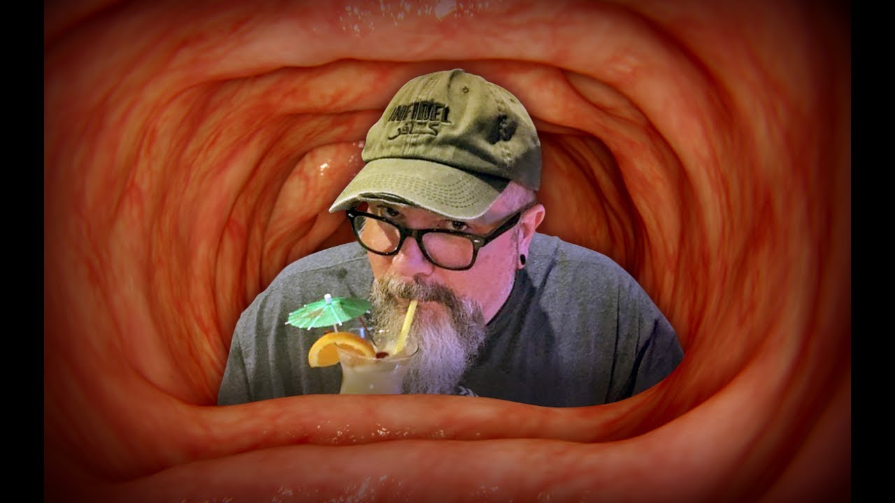 My Colonoscopy with Diverticulosis and Bonus Polypectomy! - YouTube