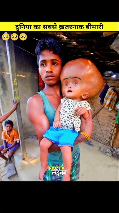 दुनिया का सबसे ख़तरनाक बीमारी 😱 | World's Biggest Head Girl | by Facty Ladka - YouTube