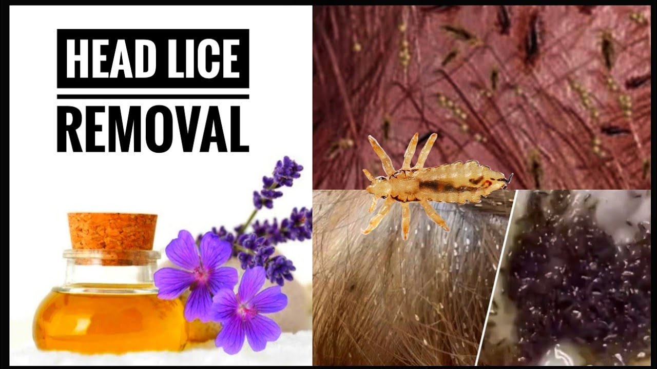 HOW TO GET RID OF HEAD LICE PERMANENTLY & FAST|LICE REMOVAL - YouTube