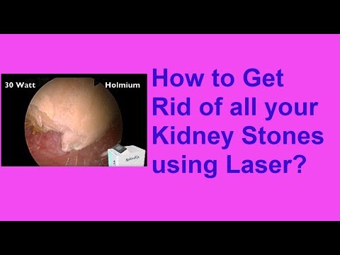 Latest Treatment for Kidney Stones (Laser removal of Kidney Stone ...