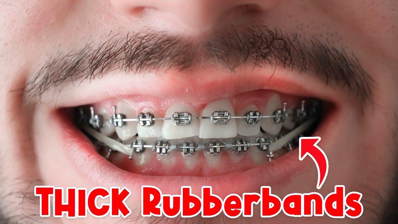 23 YEAR OLD WITH BRACES: Fixing TMJ - YouTube