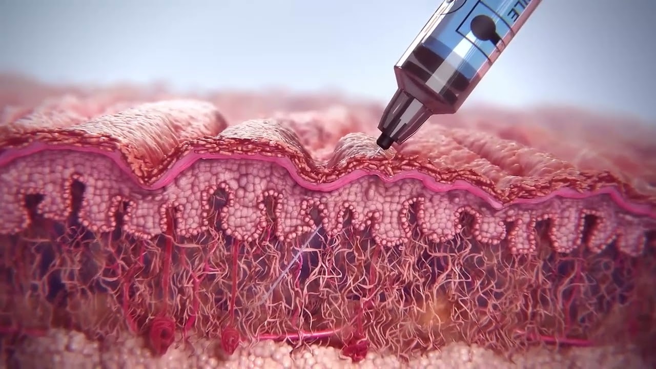 How Sculptra Works - The Injectable That Defies Aging w Results Up to ...