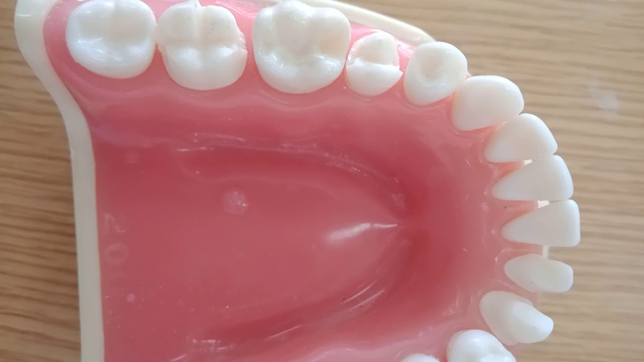 Lab 2: Partial coverage 7/8 th crown, correcting undercuts created ...