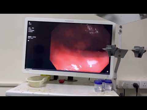 Portal hypertensive colopathy changes - YouTube