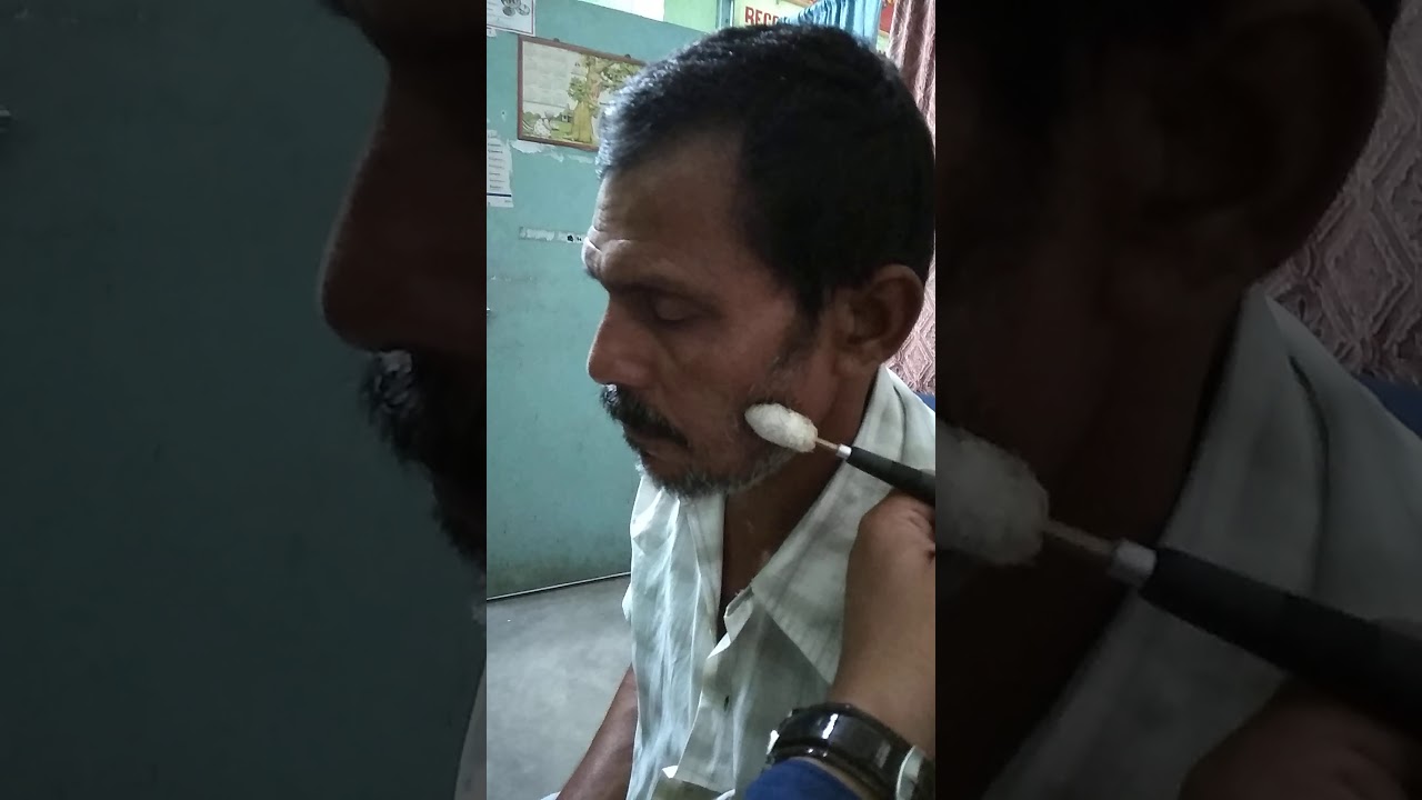 Bell's palsy. Galvanic electrical stimulation - YouTube