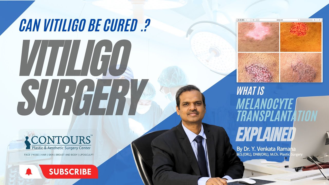 VITILIGO | LEUKODERMA | WHITE PATCHES | MELANOCYTE TRANSPLANTATION | Dr ...