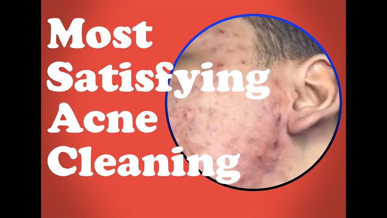 Milia most Satisfying Acne Cleaning Part 2 - YouTube