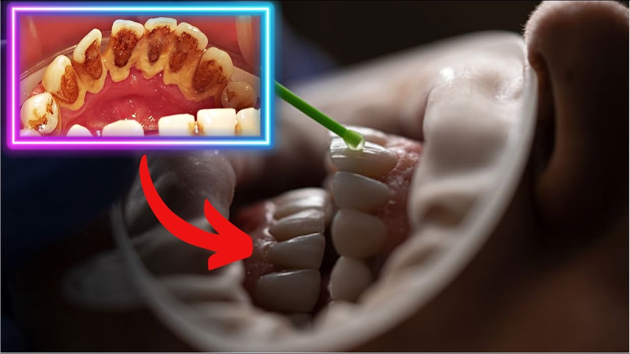 Exploring Terrible Teeth: Tooth under Microscope 2024 - YouTube