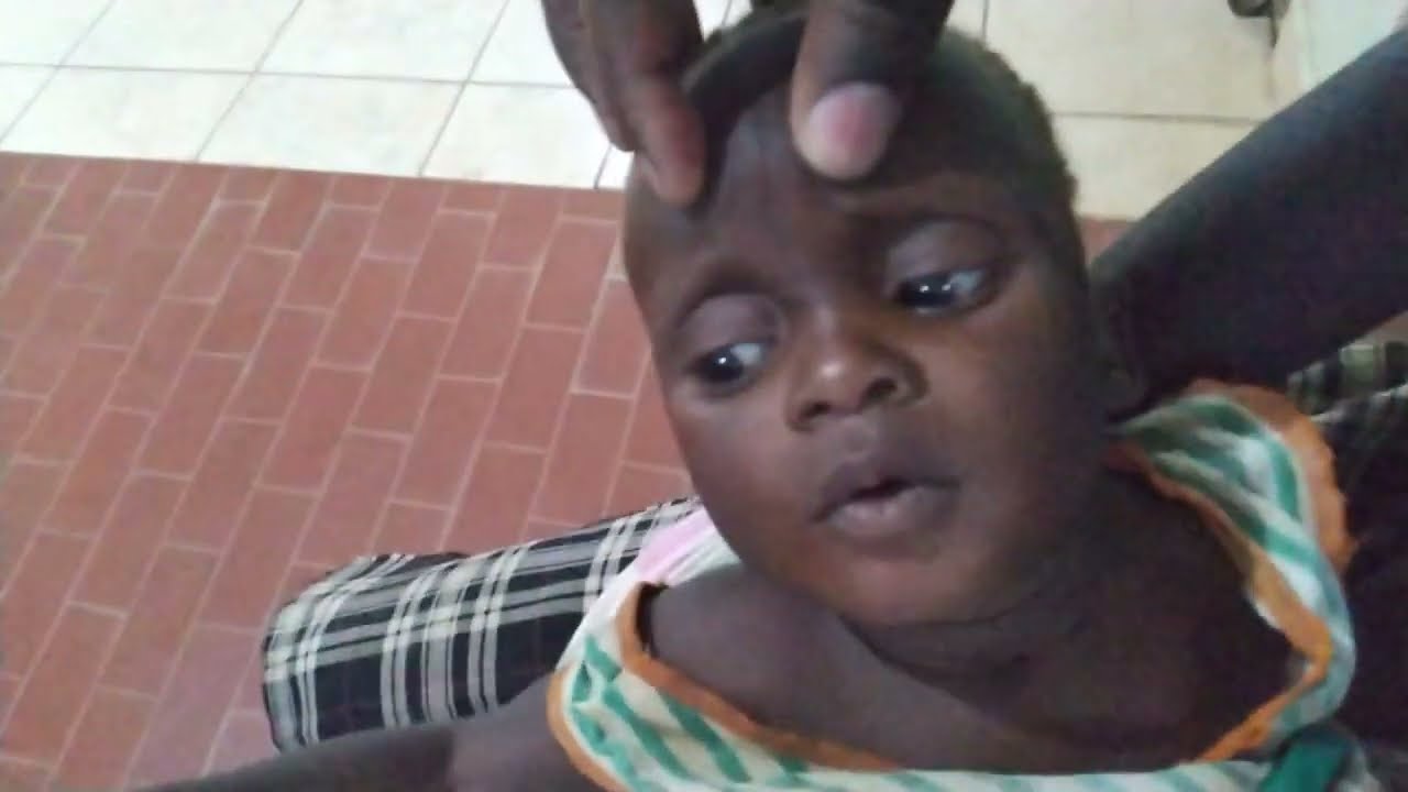 Signs Of Severe Dehydration And Danger Of Dehydration sunken Eyes YouTube Signs Of Severe Dehydration And Danger Of Dehydration sunken Eyes YouTube