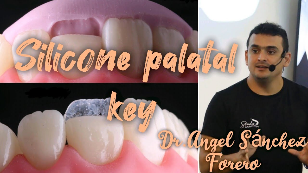 Silicone palatal key. direct palatal index composite. Dr.Angel Sanchez ...