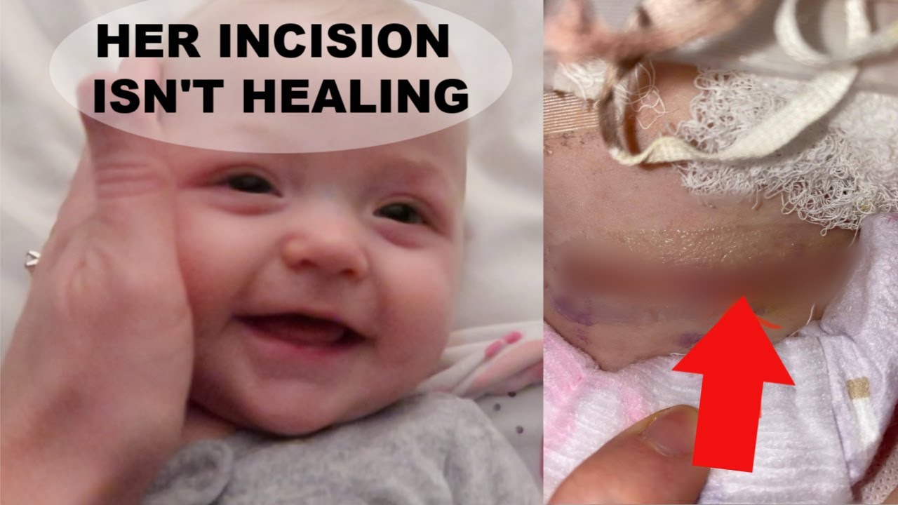 Our infants surgical incision isn't healing well. - YouTube
