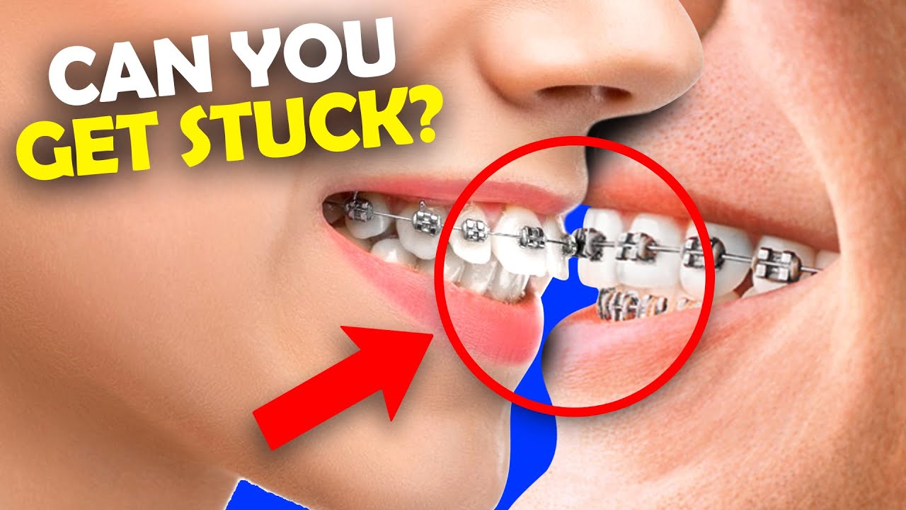 Busting the BIGGEST Braces Myths... - YouTube