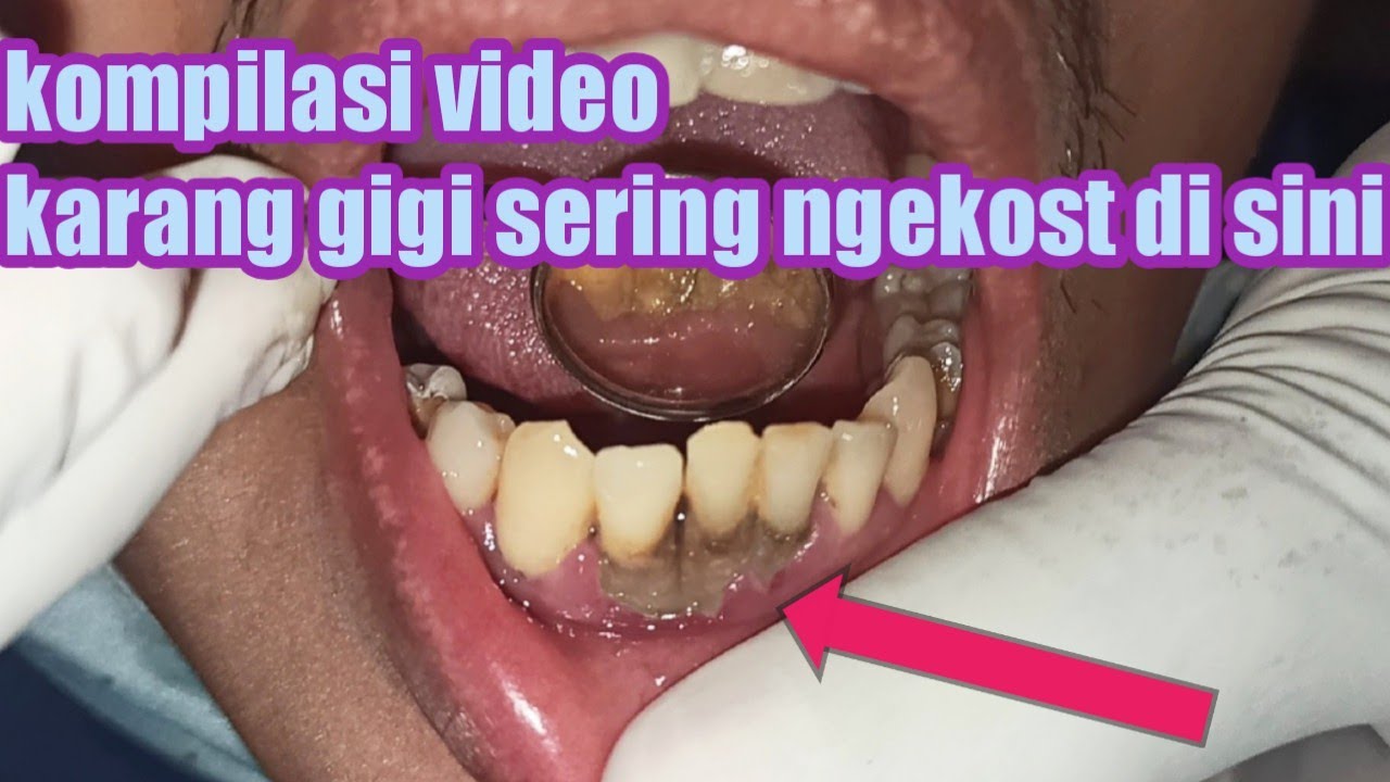 kompilasi karang gigi yang sering sekali ditemui|giant dental calculus ...